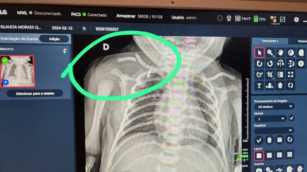 Recém-nascido tem a clavícula quebrada durante parto no Hospital ...